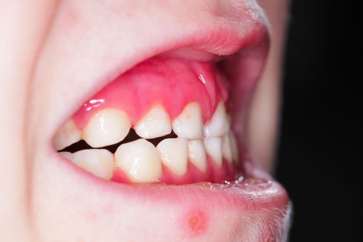 Gingivita la copii: cauze, simptome, tratament | Dr. Max Farmacie