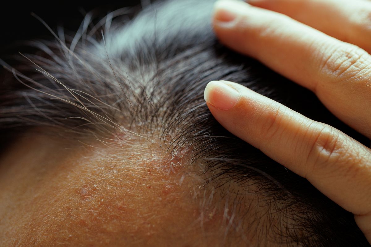 Cele mai populare sampoane pentru dermatita seboreica: sfaturi si ...