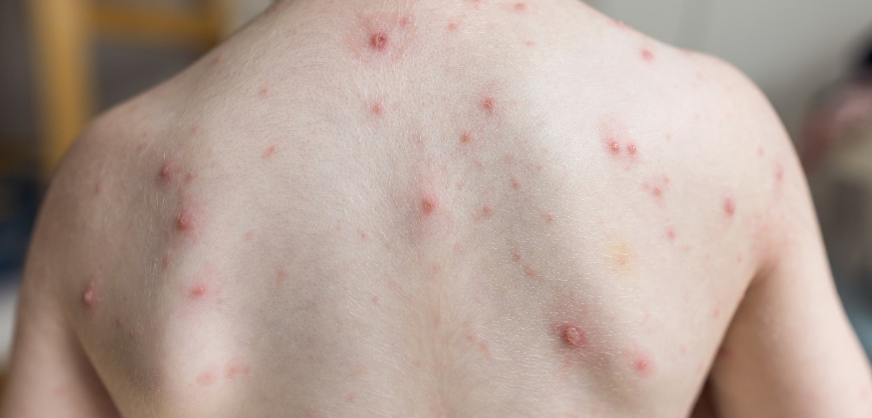 Ovčie kiahne u detí: jemná pomoc a tipy, ktoré ocení každá mama ...