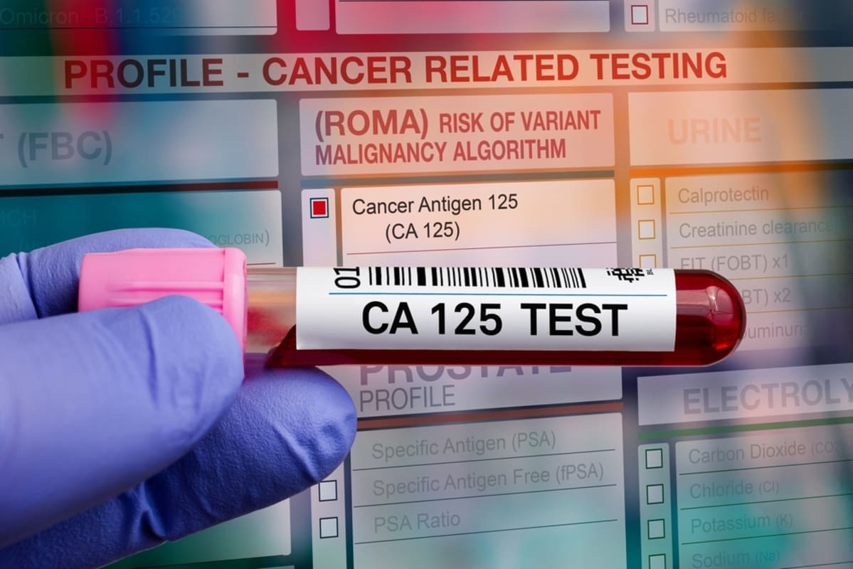 Marker tumoral CA 125: ce este, valori, afectiuni asociate | Dr. Max ...