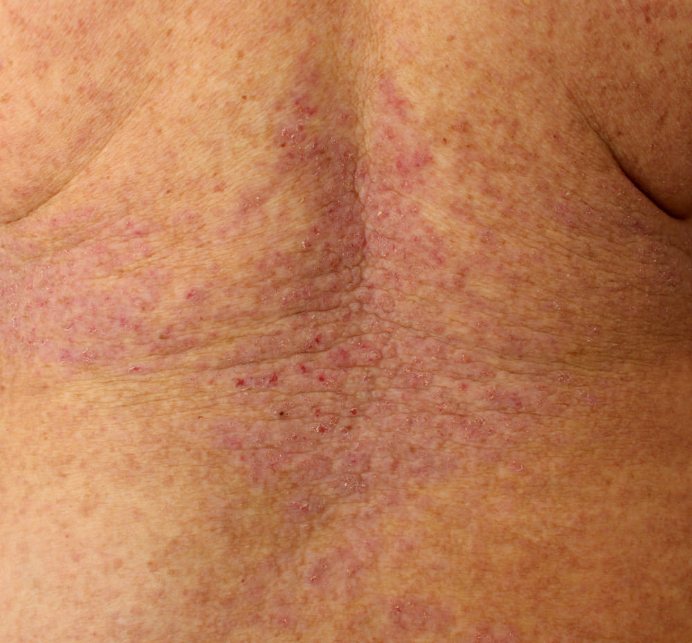 Boala Darier: cauze, simptome, tratament | Dr. Max Farmacie