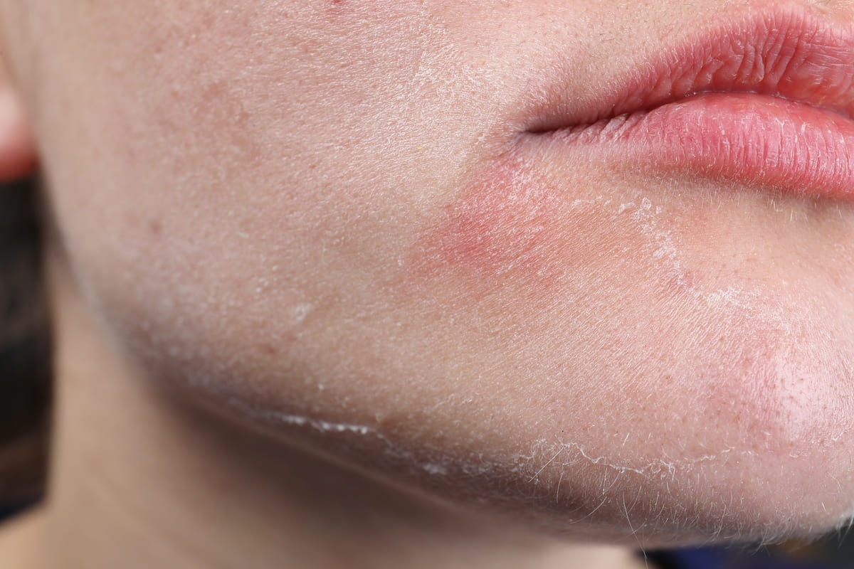 Dermatita exfoliativa: cauze, simptome, tratament | Dr. Max Farmacie